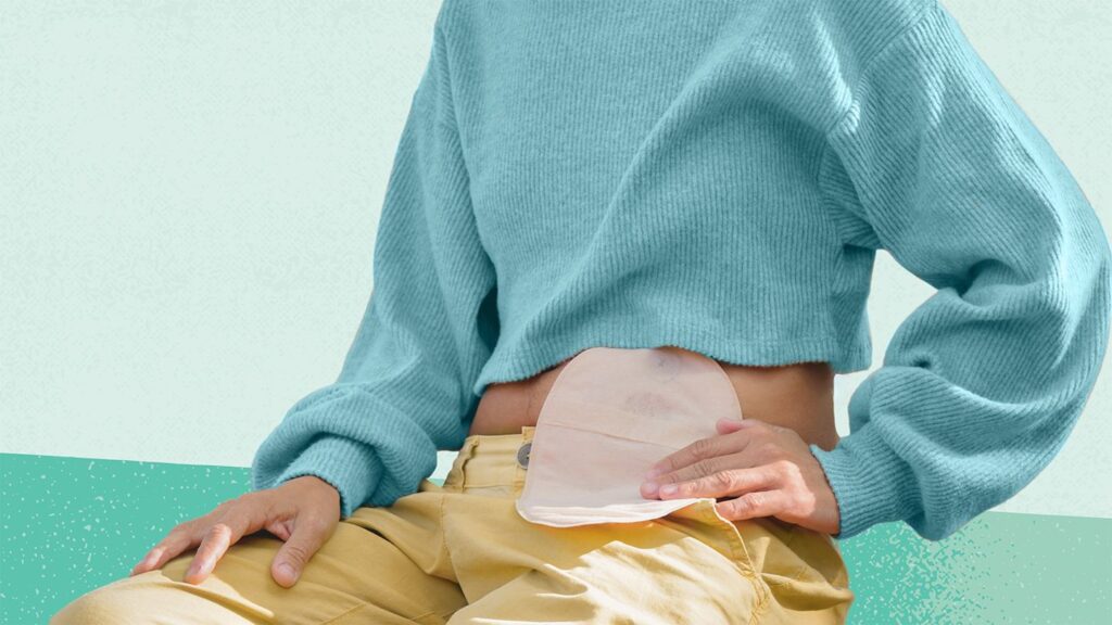Colostomy Care by expert at homely comfort